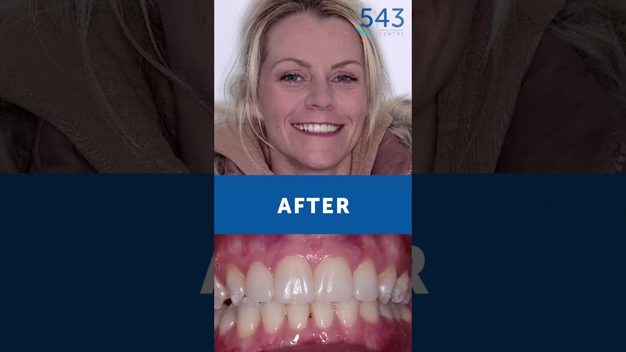 Veneers Before and After #invisalign