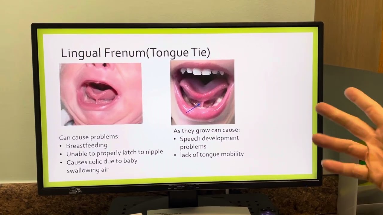 What is a Lip Tie and a Tongue Tie?