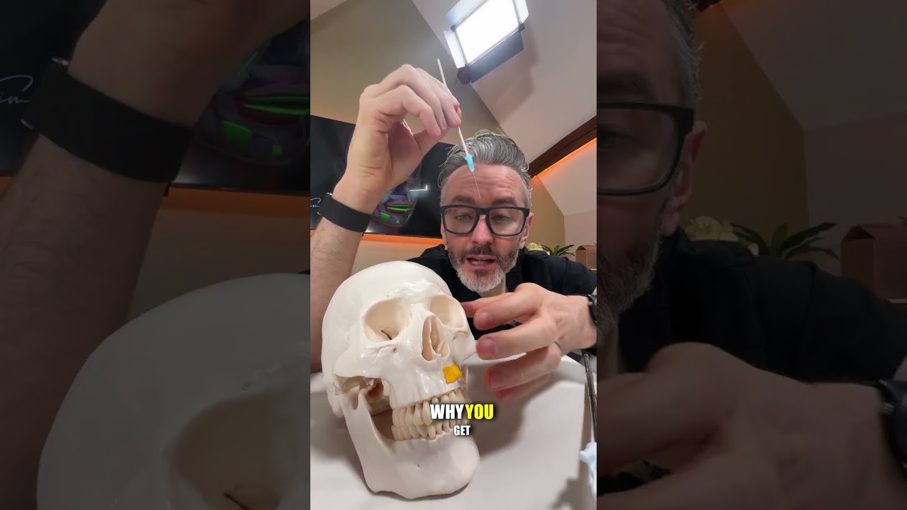 What happens when you inject filler in the nasolabial fold