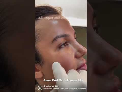 FoxEyes Surgery | Before And After | Dr. TAS
