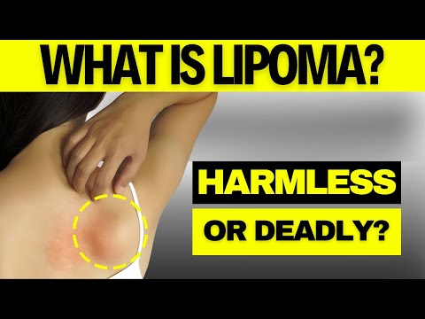 What is Lipoma? Harmless or Deadly?