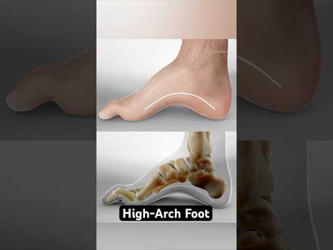 The shape of your foot could be causing your pain (3D Animation)