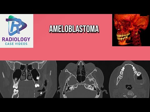 Ameloblastoma