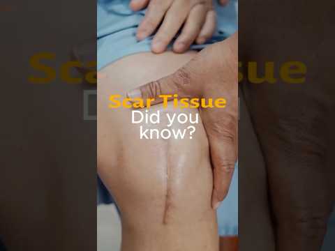 Did You Know Scar Tissue Can Be Internal AND External?