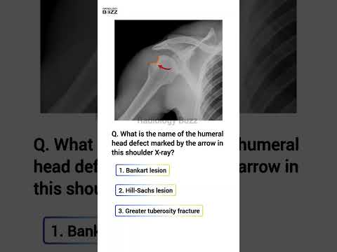 🦴 MSK Imaging Quiz: Can You Spot the Lesion?🤔 #radiologybuzz #anatomy