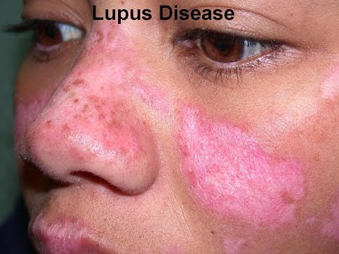 Lupus Illness | What is lupus? – Site Title