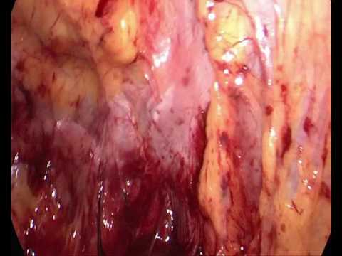 Most struggling laparoscopic repair of incisional hernia with frozen abdomen by Dr Alaa Sewefy