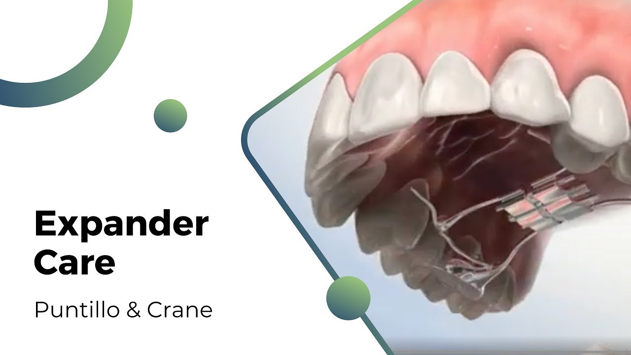 All About Your Expander!