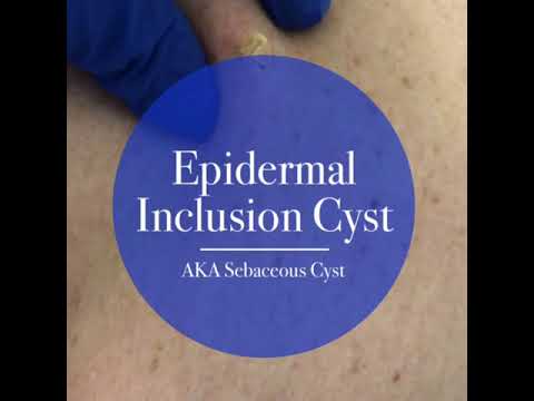 Epidermal Inclusion Cyst