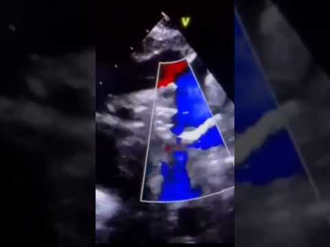 Coarctation of the aorta.