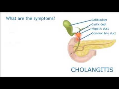 Cholangitis