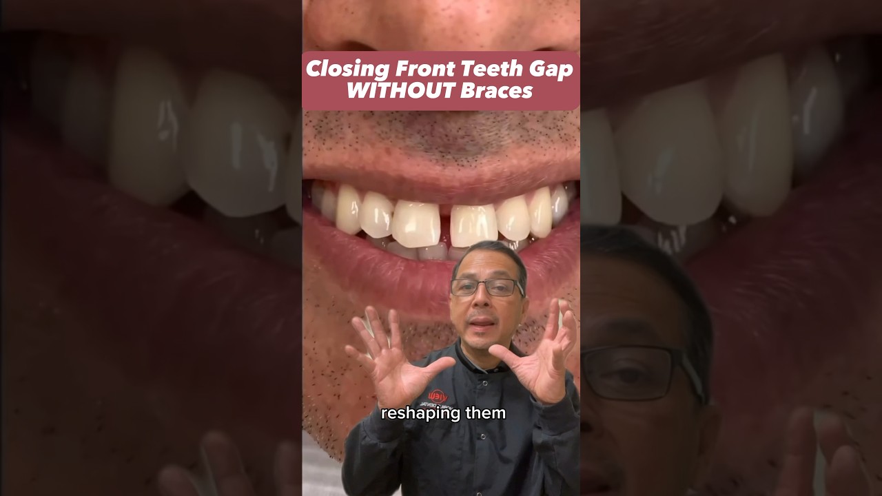 A New Smile in MINUTES (Closing a Front Tooth Gap) | View Mobile Dental #shorts