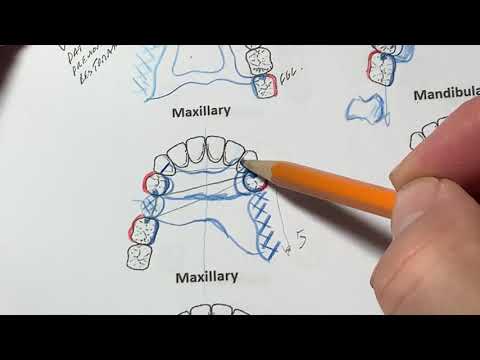 Cast Partial Denture Design Kennedy Class II
