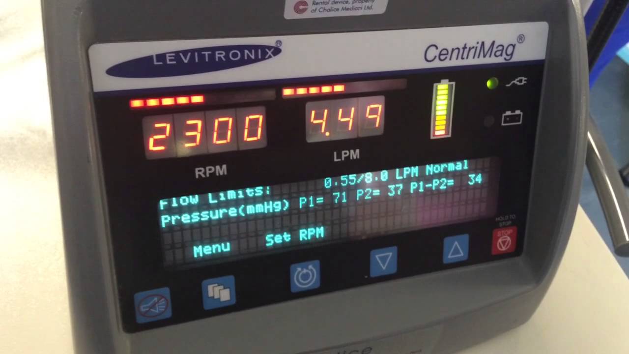 ECMO emergencies: return cannula obstruction