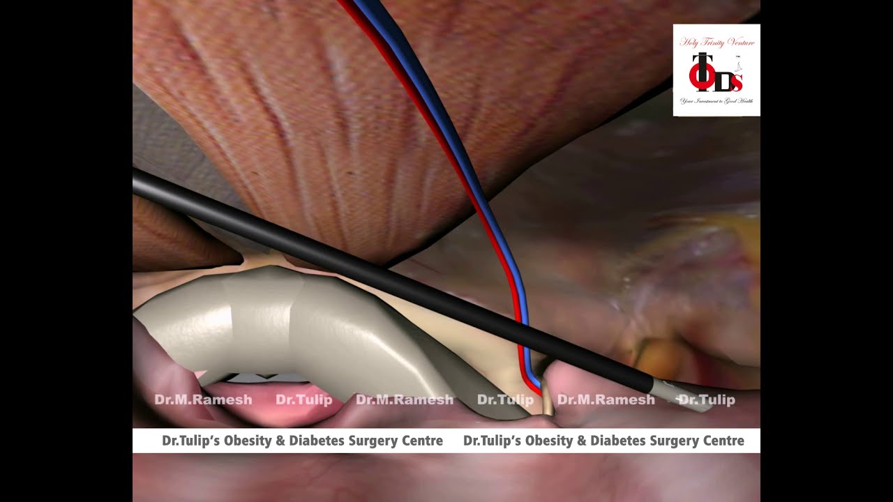 Bilateral Hernia by Totally extraperitoneal (TEP) repair Method - Animation