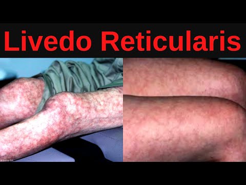 What is Livedo Reticularis? Causes, Treatment