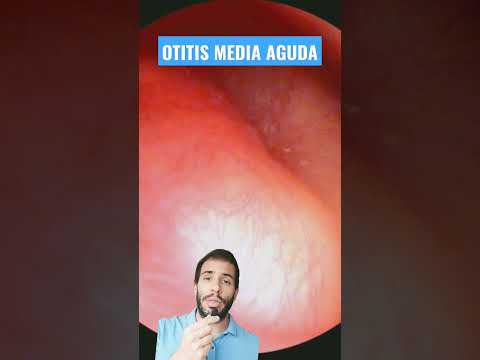 ACUTE OTITIS MEDIA