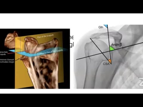 PreOp Planning and Mixed Reality in Reverse Shoulder Arthroplasty