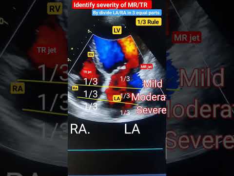 Mild, moderate,severe MR,TR in Echo by 1/3 rule #echo #shorts