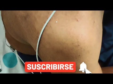Shoulder Pain Relief exercises | Adhesive capsulitis | Frozen shoulder