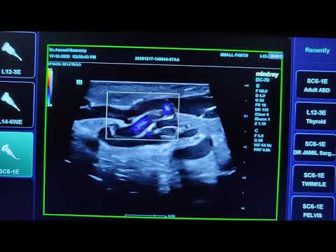 Varicocele with Reflux Ultrasound