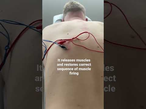 Electro acupuncture treatment for back pain