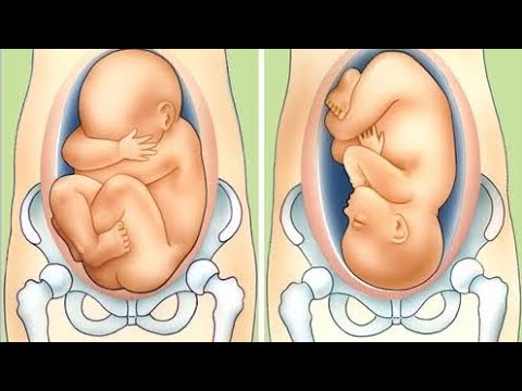 How to Determine the fetal position ? (FPD)