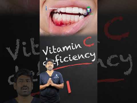 ஸ்கர்வி எனும் இரு உதட்டு நோய் வராமல் தடுப்பது எப்படி? - Vitamin C prevents Scurvy | Denta Kings