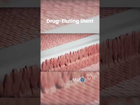 What happens after a drug-eluting stent is placed?