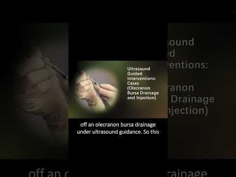 #ultrasound Guided Interventions: Cases (Olecranon Bursa Drainage and Injection)