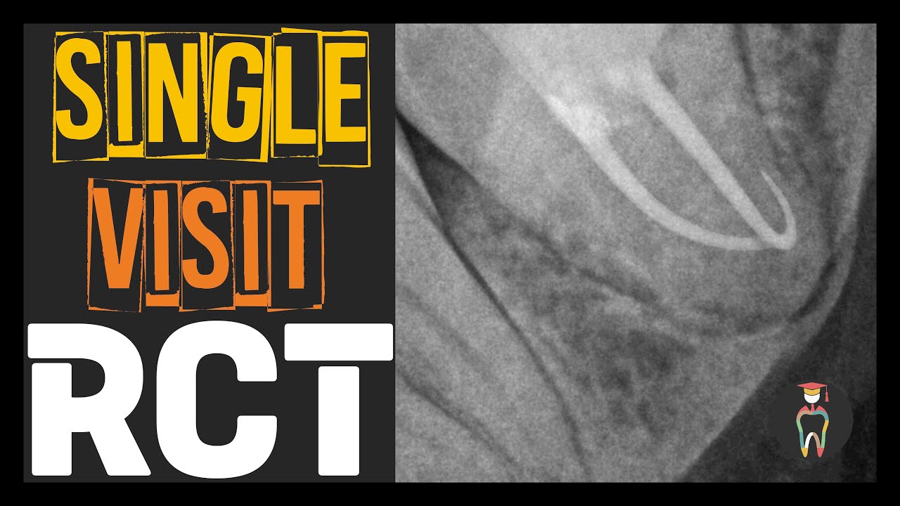 Single Visit Root Canal Treatment