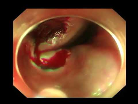 Successful endoscopic closure of chronic nonmalignant tracheoesophageal fistula