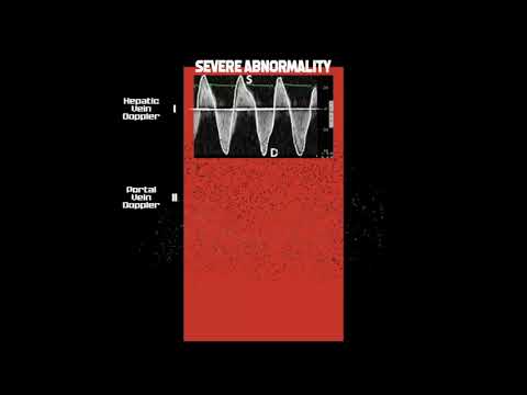 VExUS Score – Critical Care Northampton