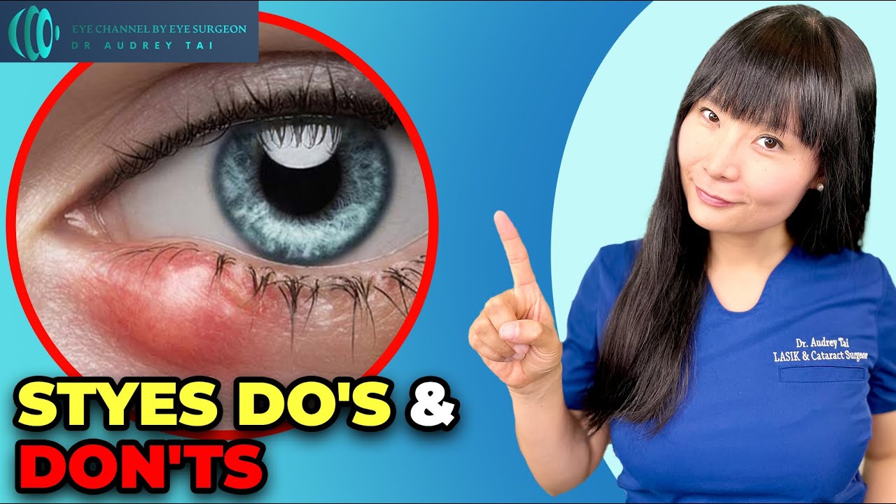 Stye Do’s and Don’ts: Everything You Need to Know in One Video| Eye Surgeon Explains (Not Sponsored)