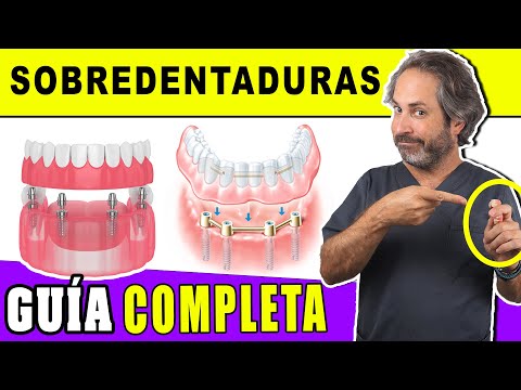 La 𝗠𝗘𝗝𝗢𝗥 y MÁS 𝗕𝗔𝗥𝗔𝗧𝗔 Prótesis Removible sobre Implantes: 𝗦𝗢𝗕𝗥𝗘𝗗𝗘𝗡𝗧𝗔𝗗𝗨𝗥𝗔 sobre 4 IMPLANTES LOCATOR