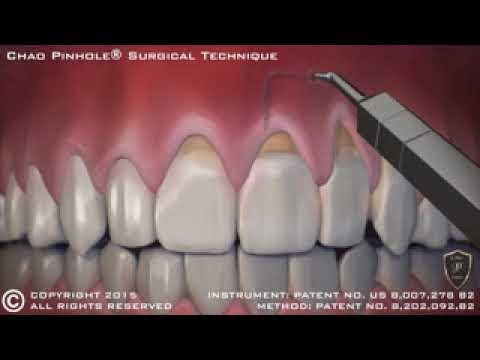 Animation (Conventional Gum Grafting)