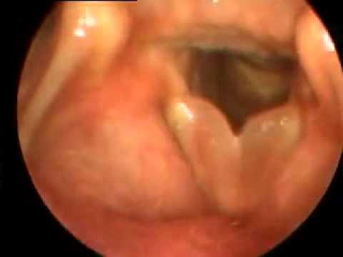 Reinkes Edema