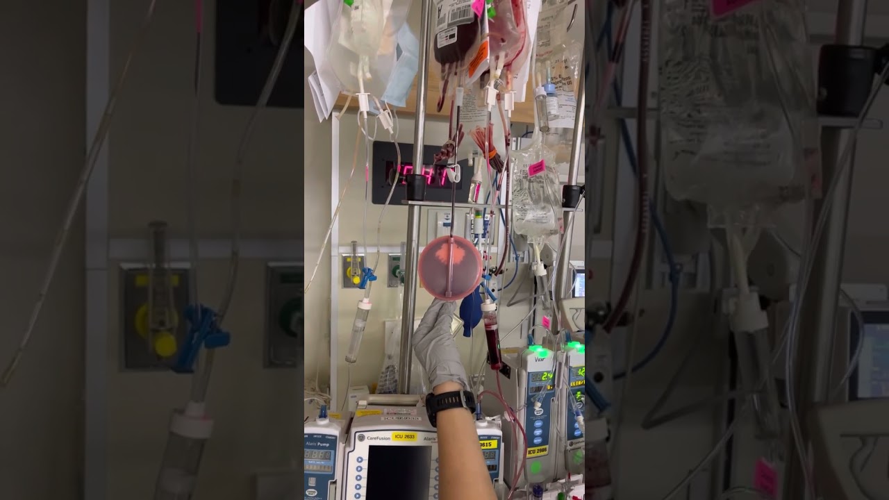 Using a leukocyte reduction filter for blood administration.