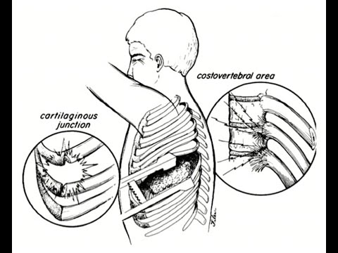 Surgical access to the Chest; Median sternotomy and Lateral thoracotomy