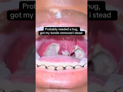 Why Getting Tonsils REMOVED Is A BIG Deal! 😮🦷