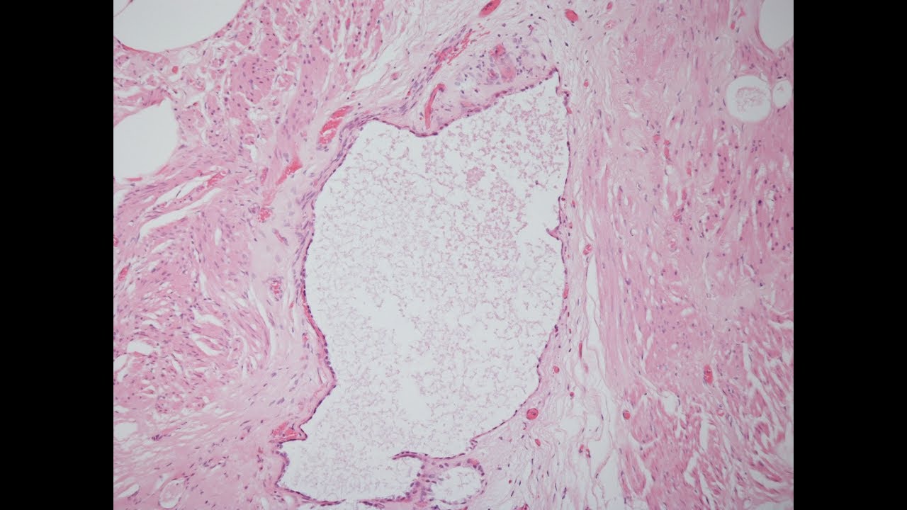 Endocervicosis - Pathology mini tutorial