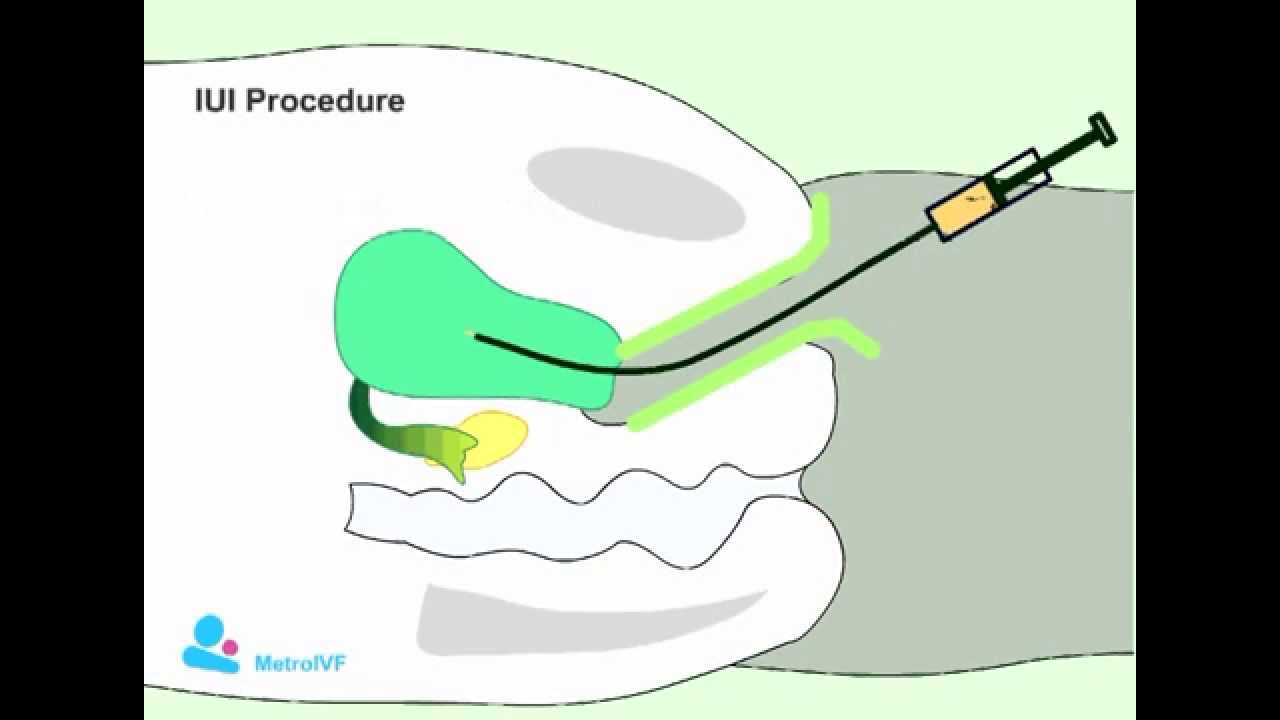 IUI procedure
