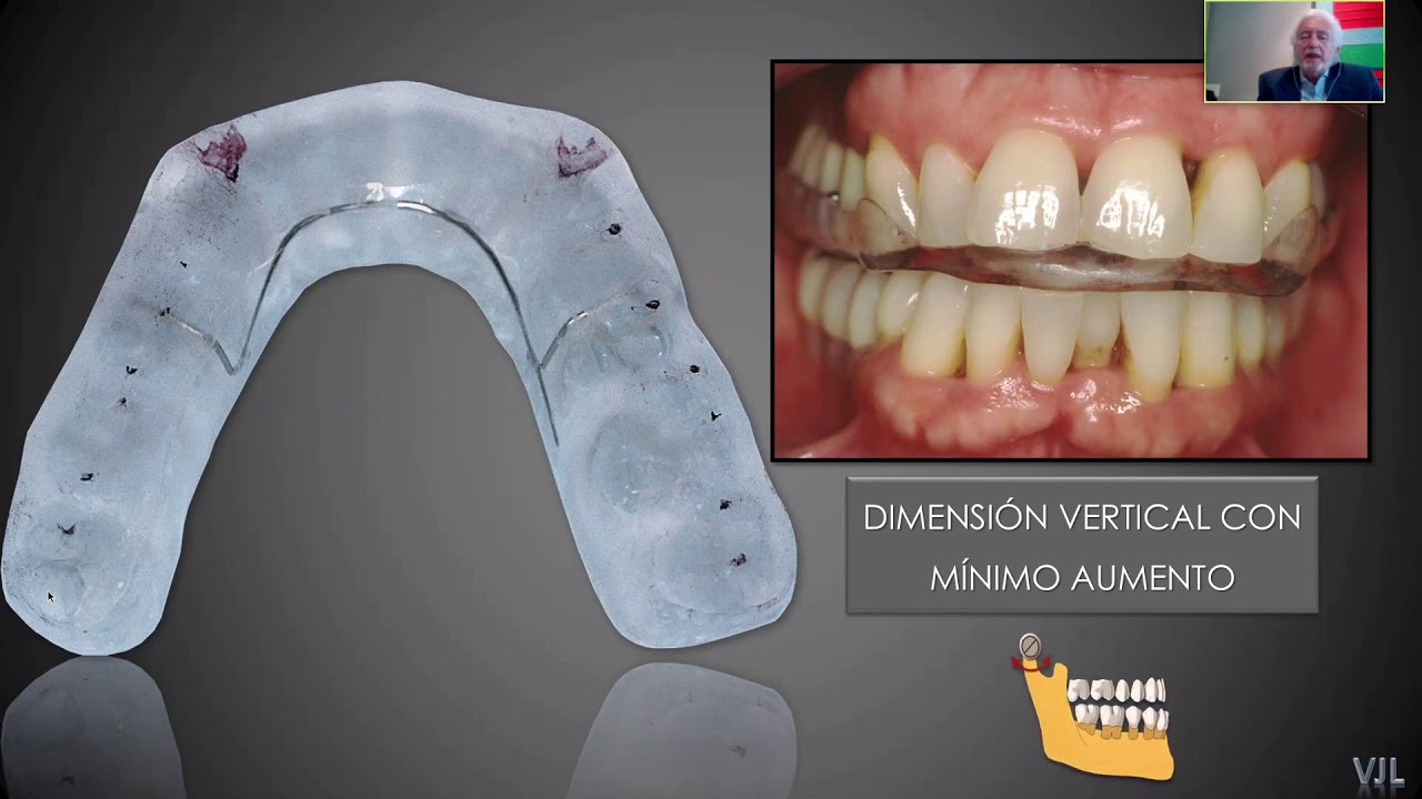 Occlusal splints: their design and adjustment (Part 1) | Dr. Vicente Jiménez
