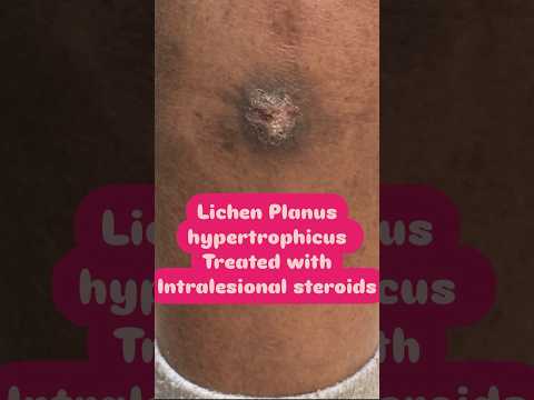 Lichen Planus hypertrophicus | PARISA skin clinic | Dr Ashima Goel MD Dermatologist