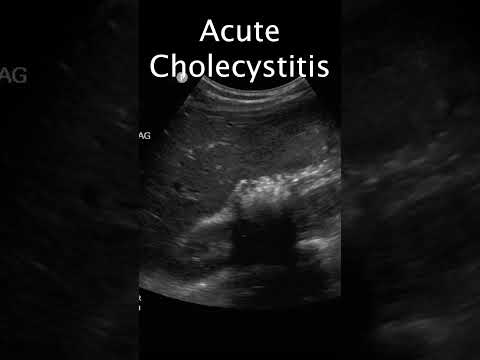 Acute Cholecystitis #emergencymedicine #surgery #cholecystitis