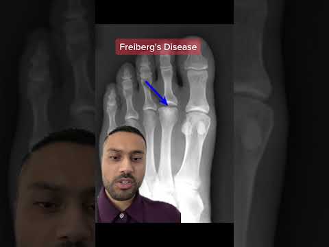 Do You Have This Painful Foot Disease?😱#health #medical #viral