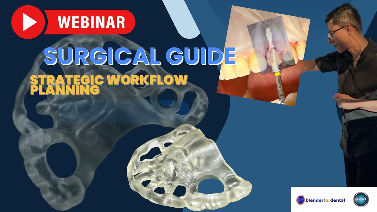 Digital Workflow in Guided Surgery: Step by Step