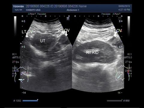 Ultrasound Video showing an ectopic kidney.