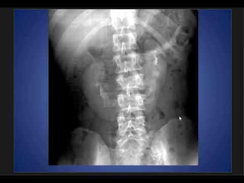 Case Discussion : Horseshoe kidneys