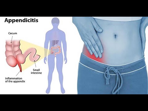 Rovsing's Sign #appendicitis